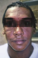 Special Edition of The Buzz: New Facial Filling Treatment for Lipodystrophy